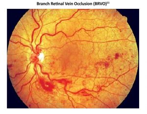 Retinal Vein Occlusion Symptoms: Disease Education: Vision RELIEF